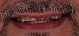Bite Disease: Your Teeth Are an Important Part of Your Digestive System