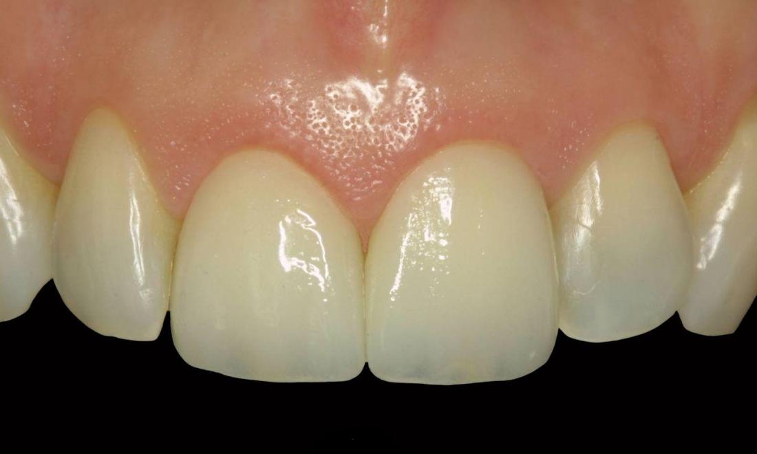 I Need Two Front Teeth